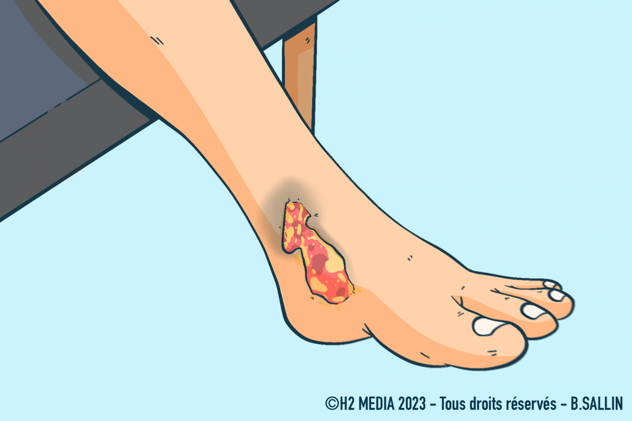Ulcère de jambe et pied diabétique - H2Media
